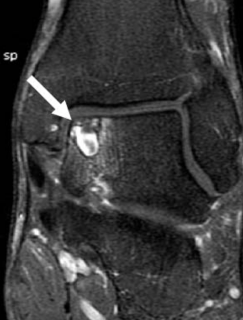 Alternate Ankle Surgeries - The Ankle Surgeon